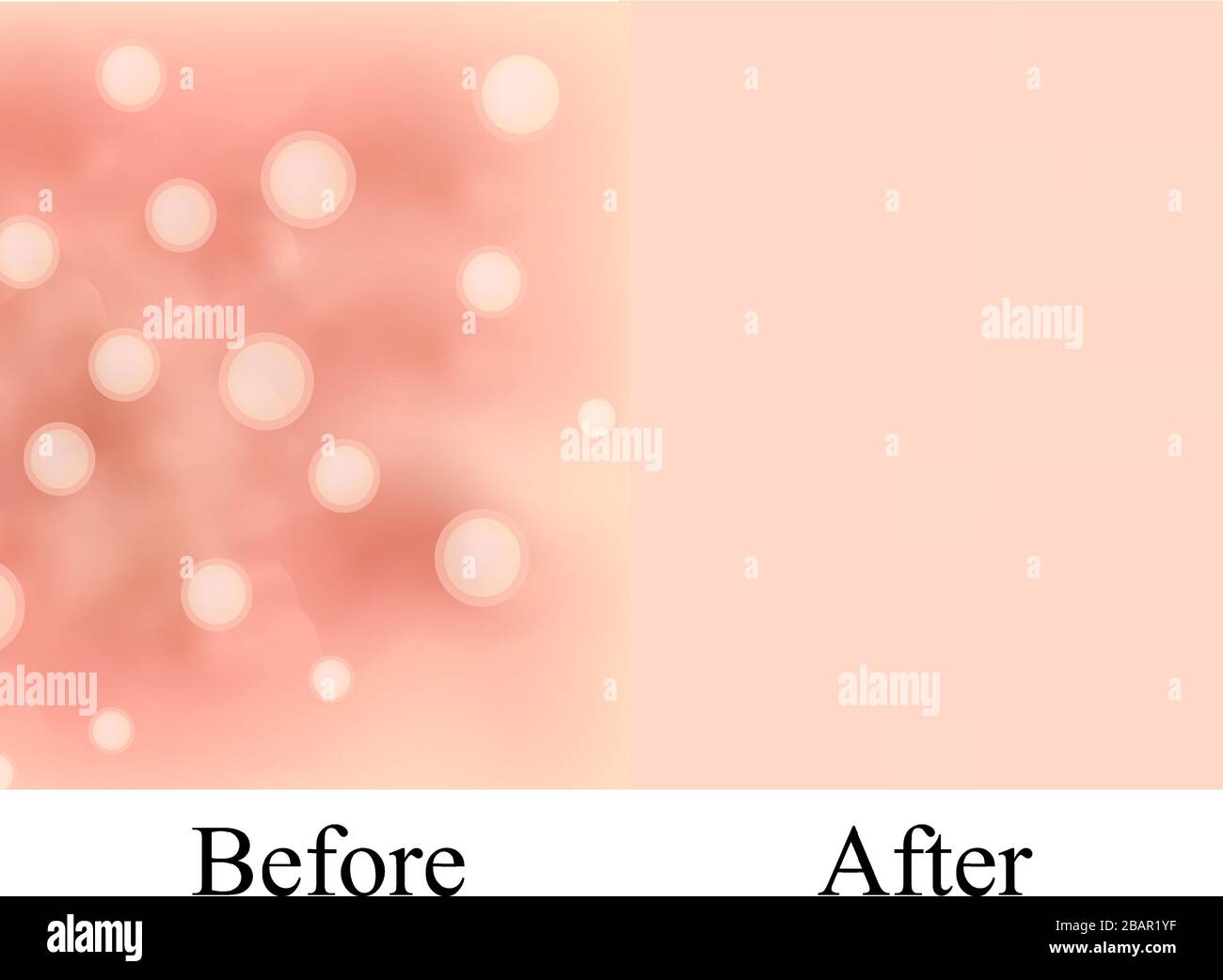 Texture, inflamed pimples and acne. Before After acne. Skin background ...