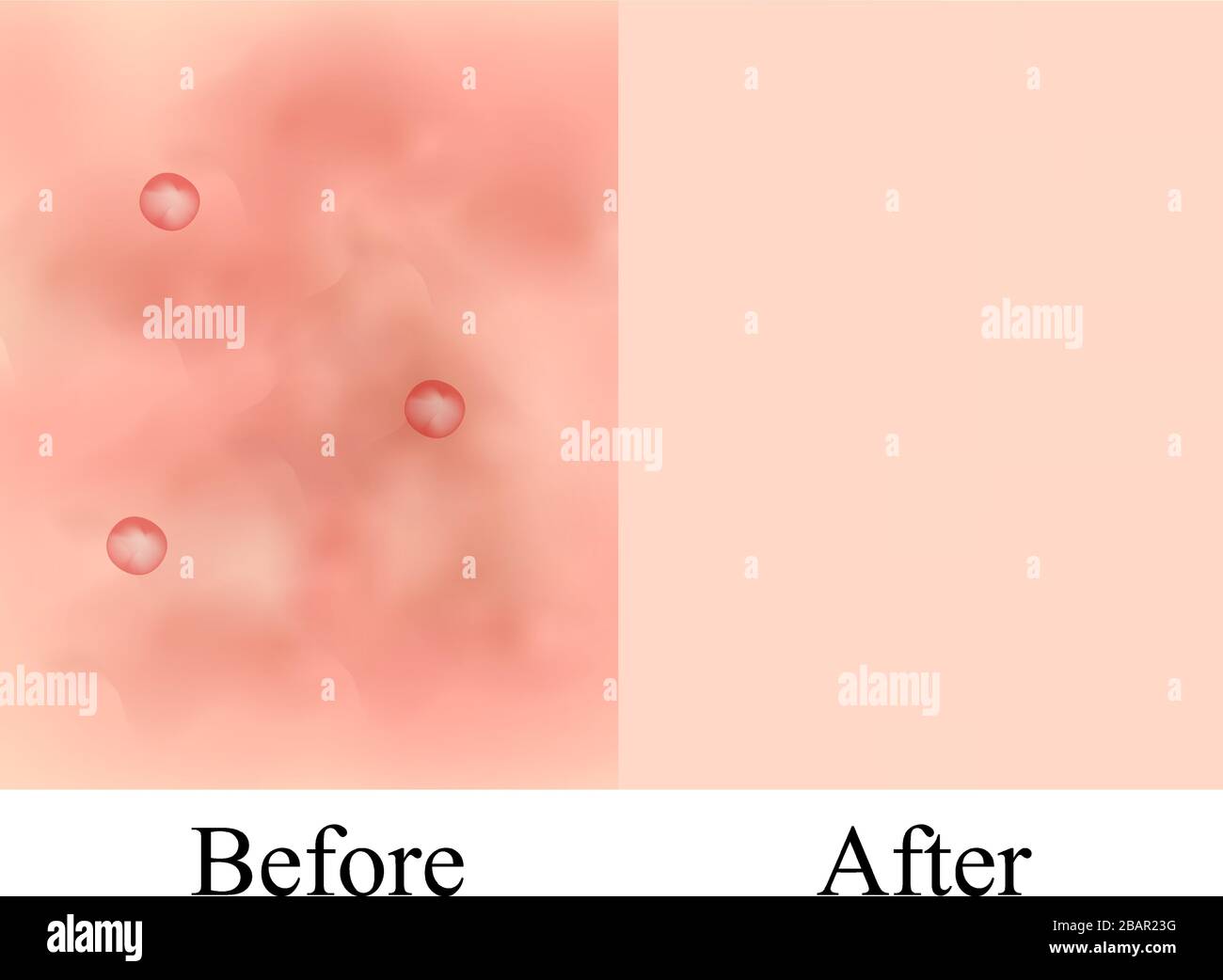 Texture, inflamed pimples and acne. Before After acne cysts. Skin ...