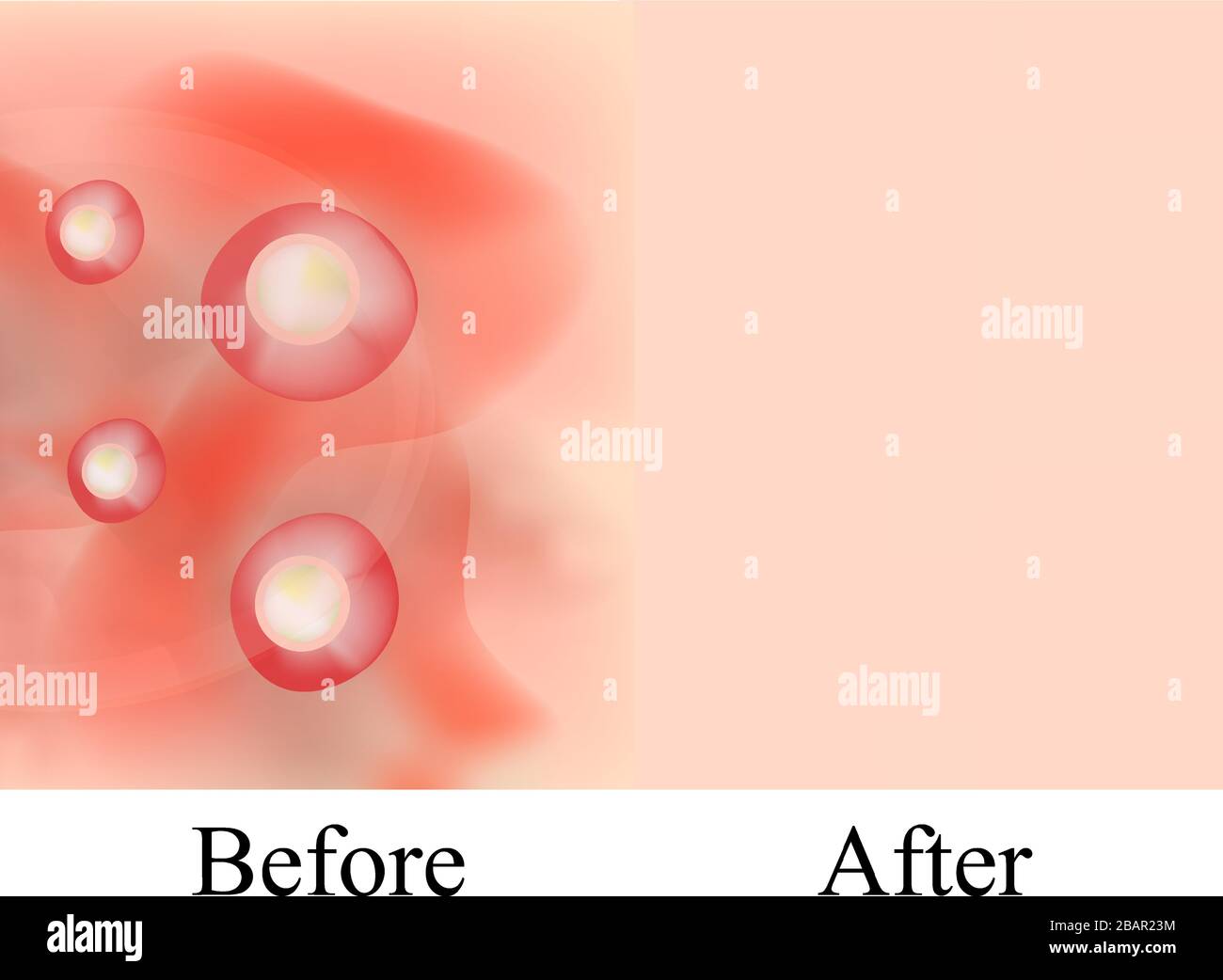 Texture, inflamed pimples and acne. Before After acne cysts. Skin ...