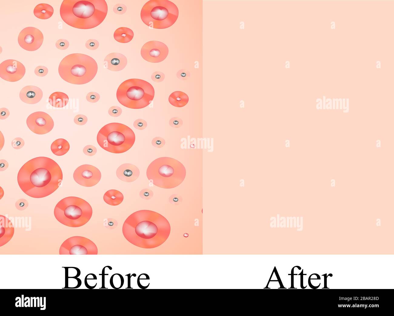 Texture, inflamed pimples and acne. Before After acne cysts. Skin ...
