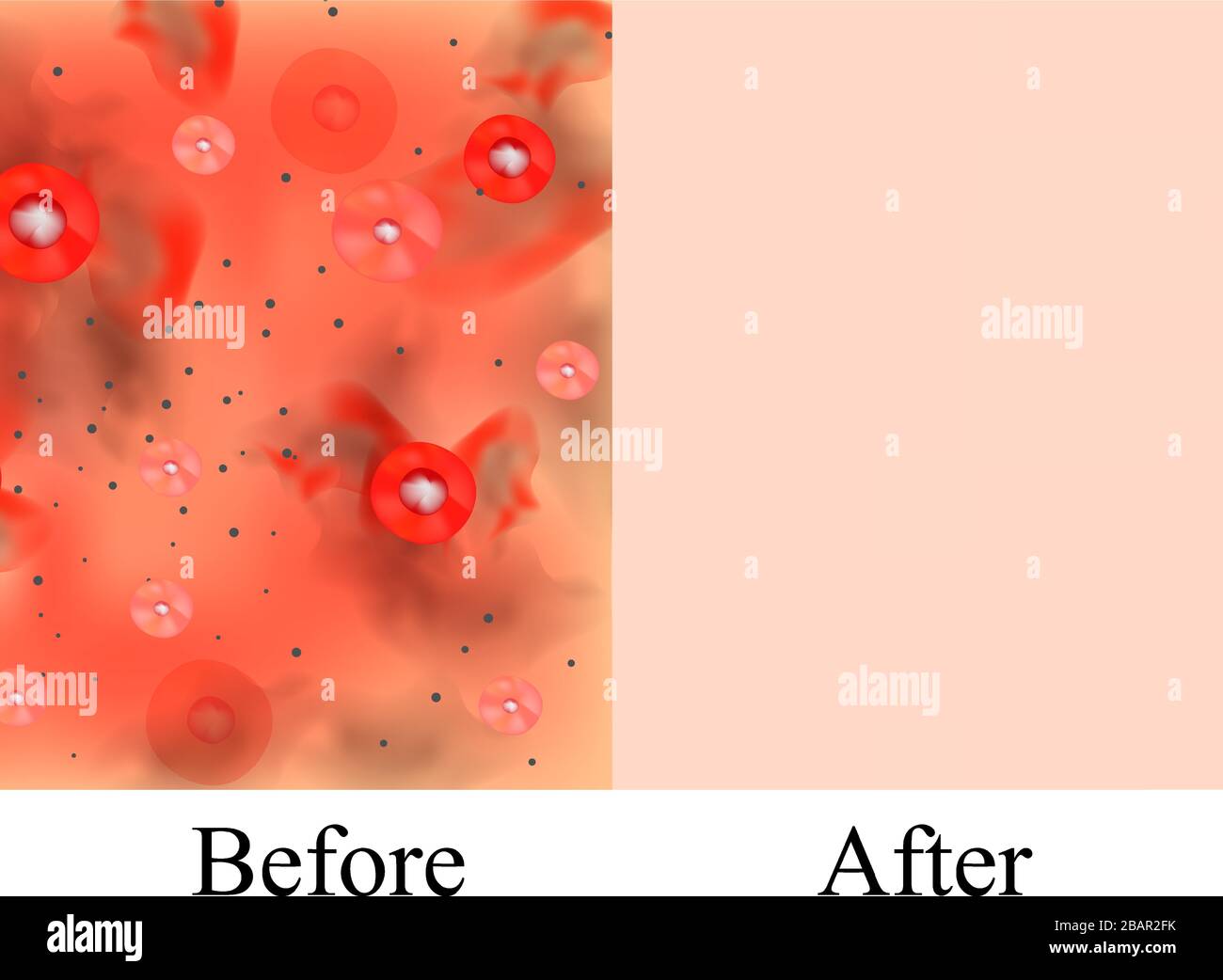 Texture, inflamed pimples and acne. Before After acne cysts. Skin ...