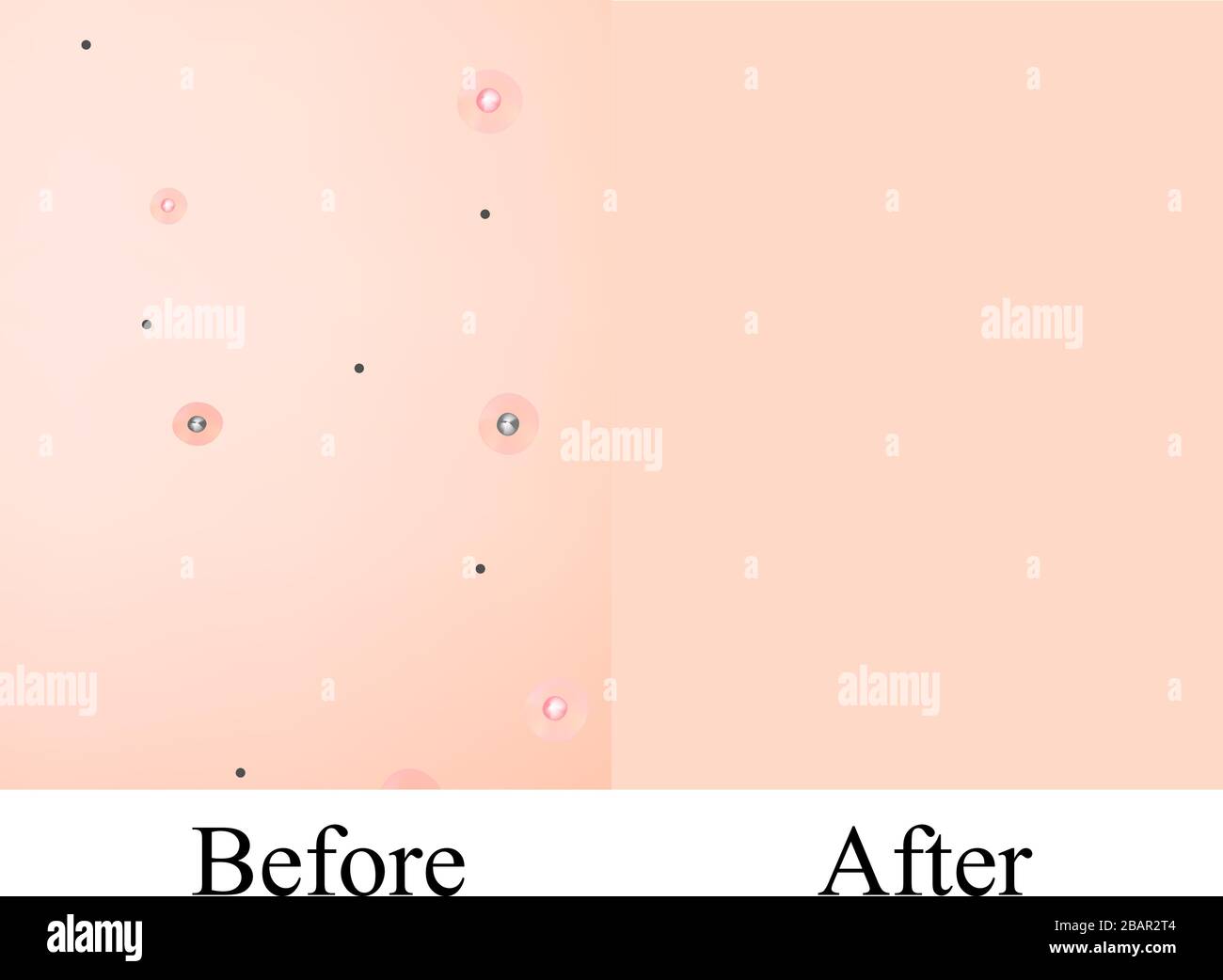 Texture, inflamed pimples and acne. Before After acne. Skin background ...