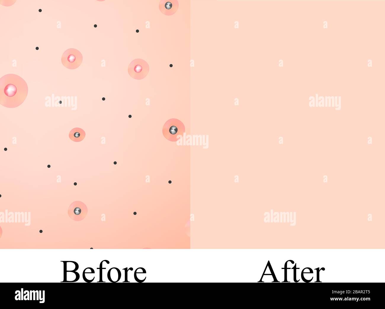 Texture, inflamed pimples and acne. Before After acne. Skin background ...