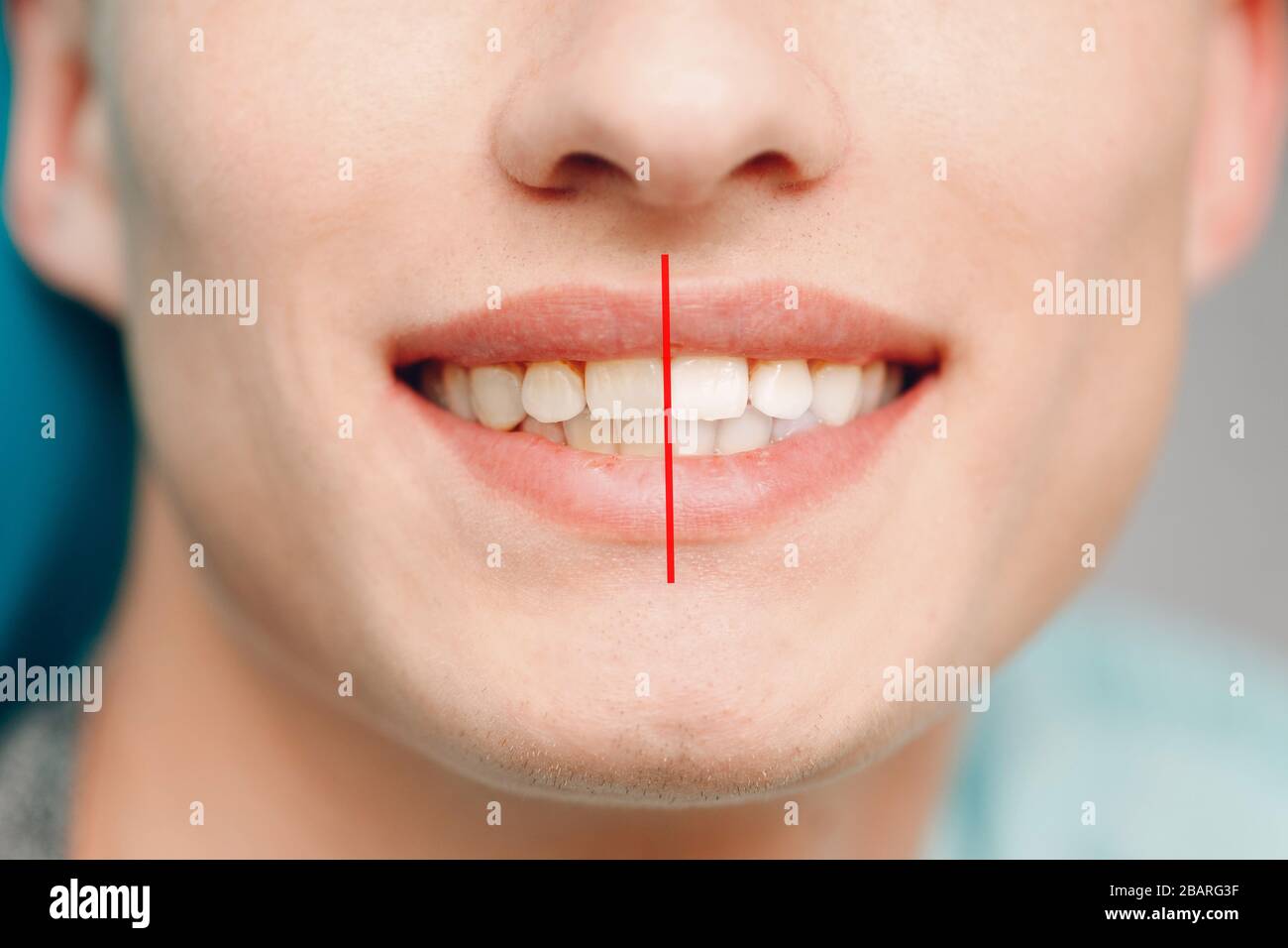 Whitening teeth. Before and after procedure. .Dentistry. Dental clinic ...