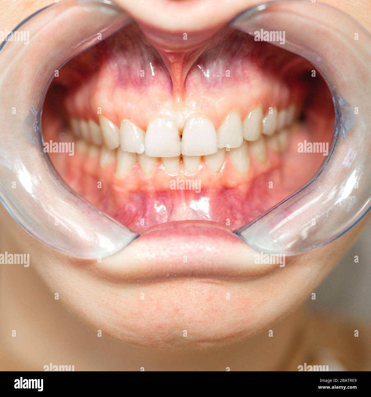 Whitest Teeth In The World