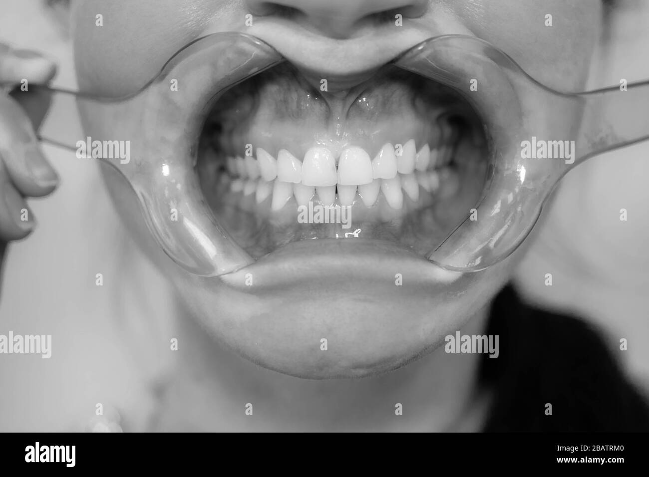 Dental mouth spreader, before teeth whitening Teeth woman at the ...