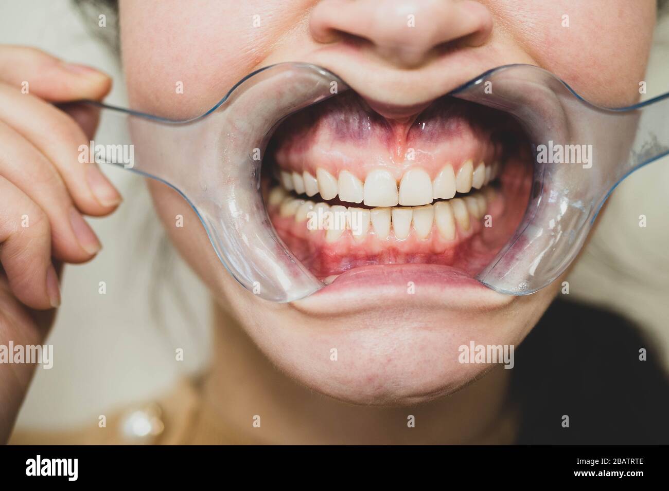 Dental mouth spreader, before teeth whitening Teeth woman at the ...