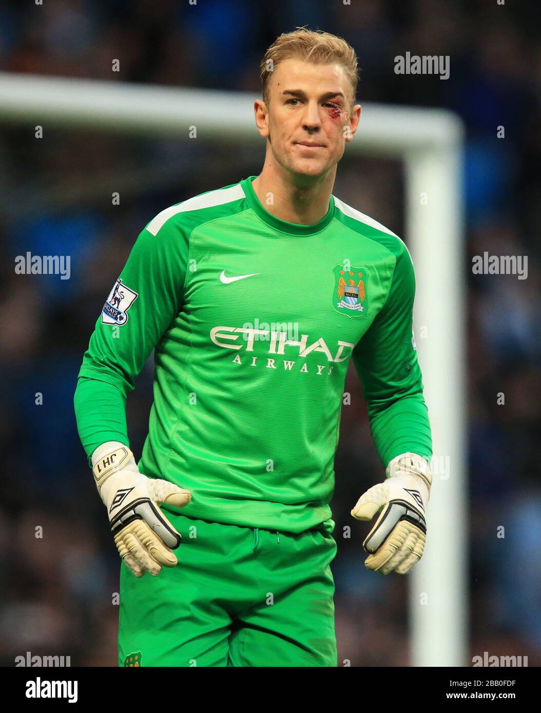 Joe Hart Eye