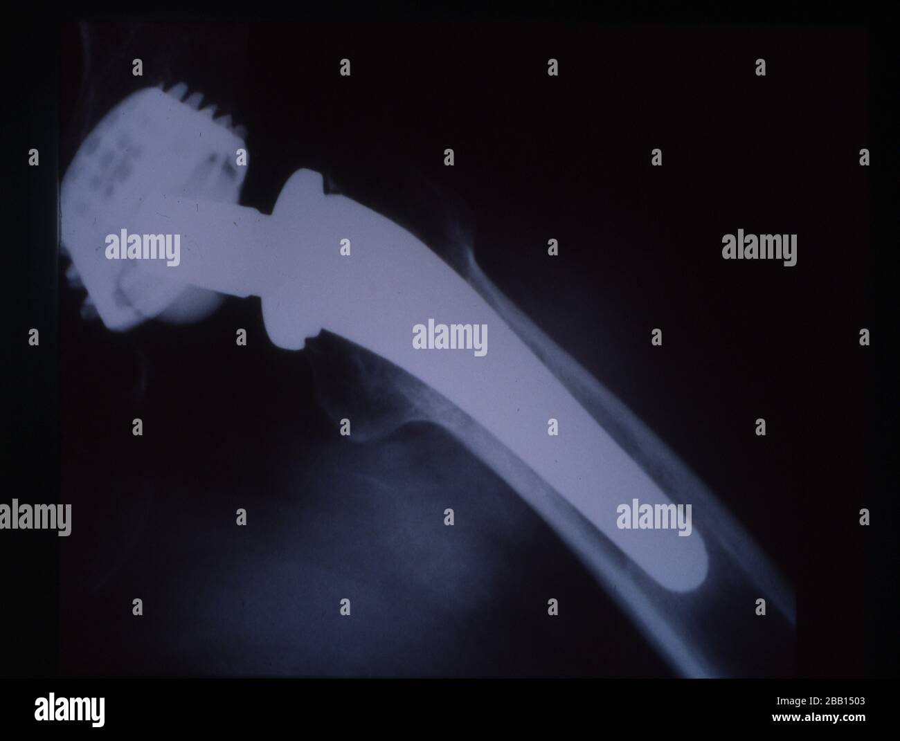 Artificial hip joint in the human thigh X-ray image Stock Photo - Alamy