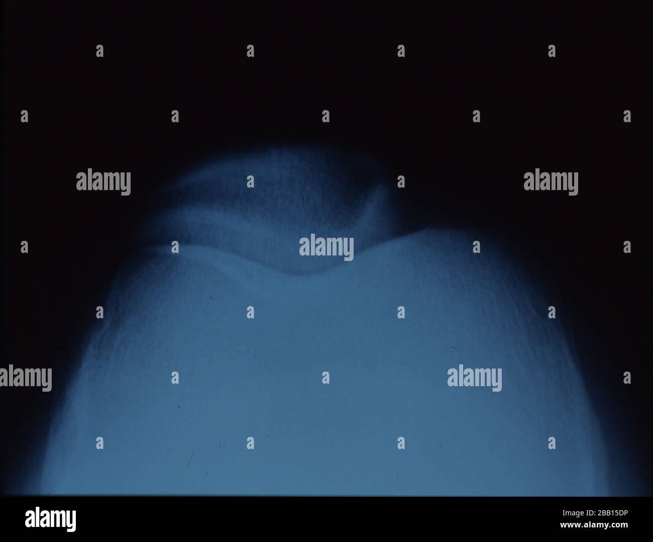 Kneecap hi-res stock photography and images - Alamy