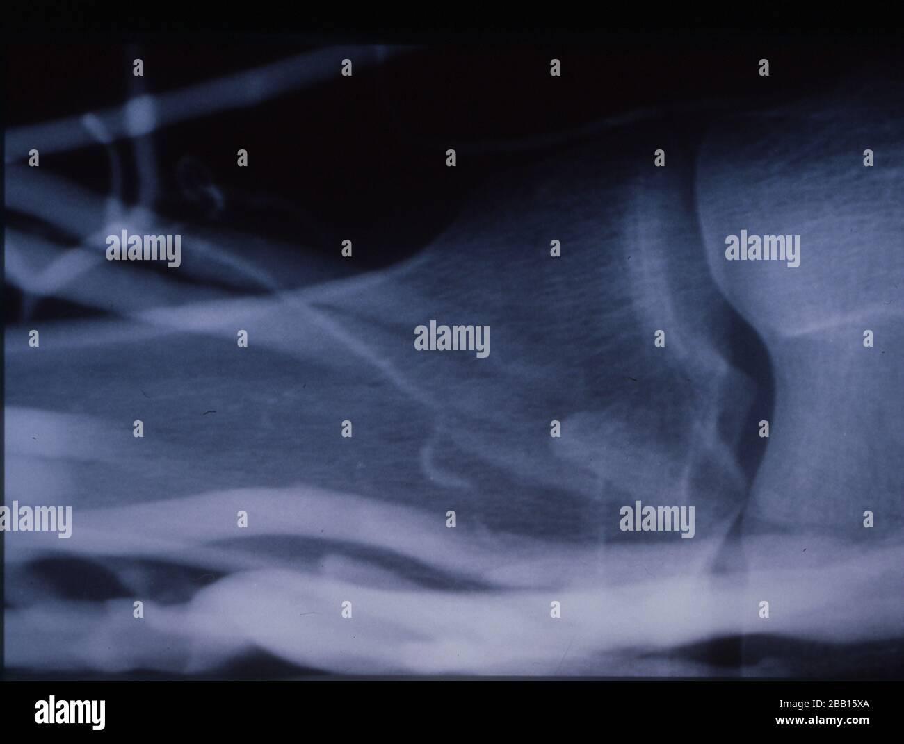 x-ray from leg Stock Photo - Alamy