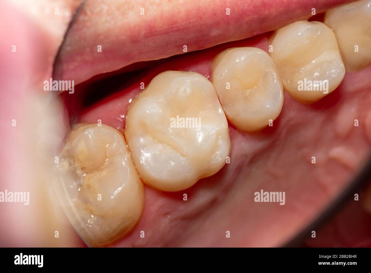 treatment tooth decay with subsequent filling with photopolymer ...