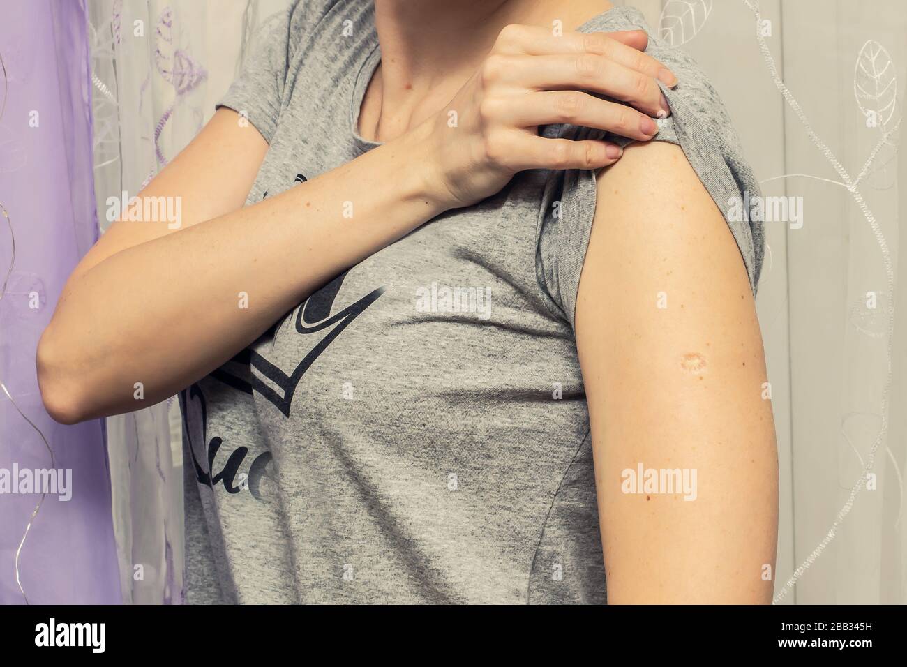 Woman with smallpox following BCG vaccination against TB vaccine on her ...