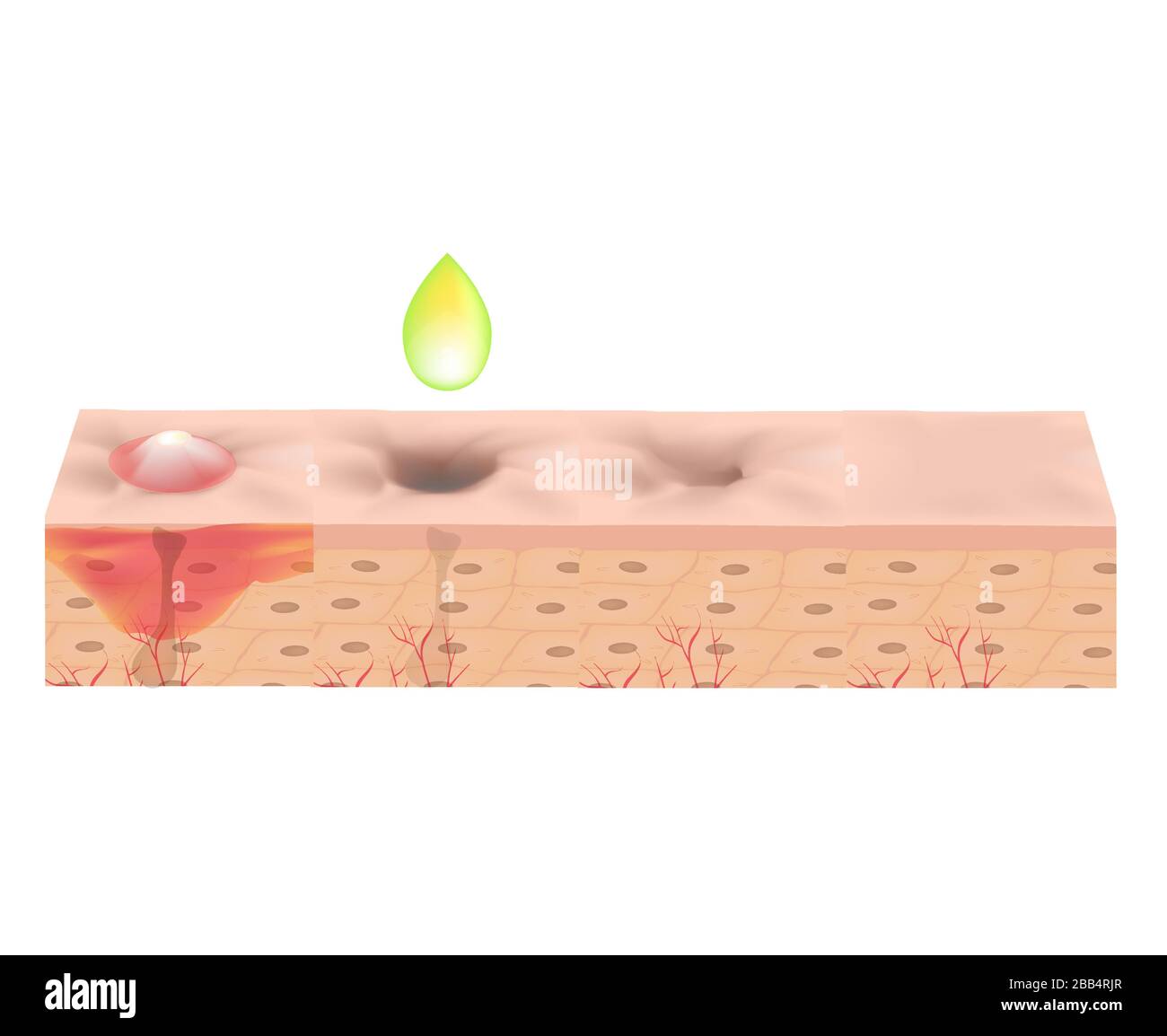 Atrophic scars. Acne scar. The anatomical structure of the skin with ...