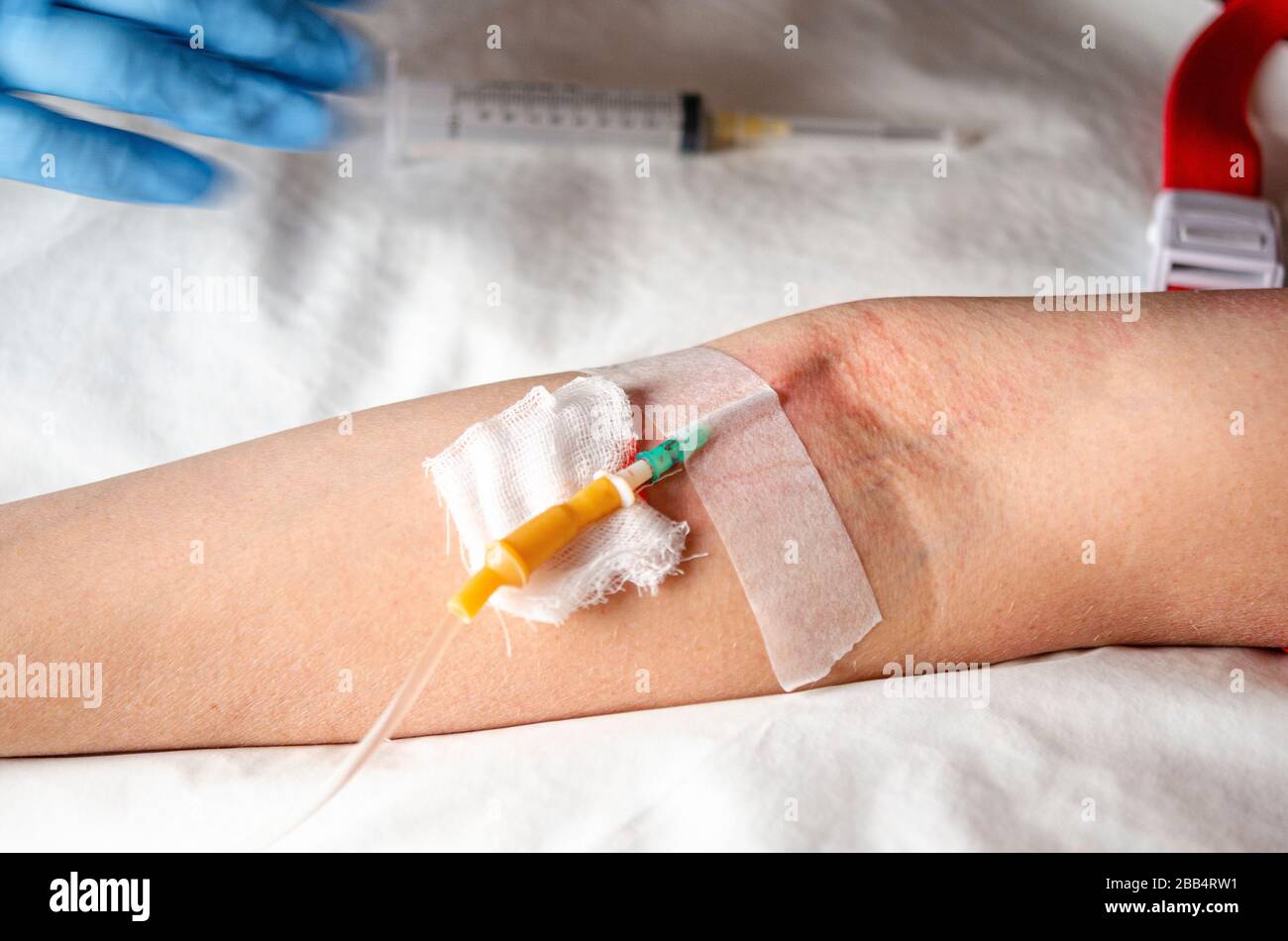 The needle of the drip stands in the vein for the introduction of ...