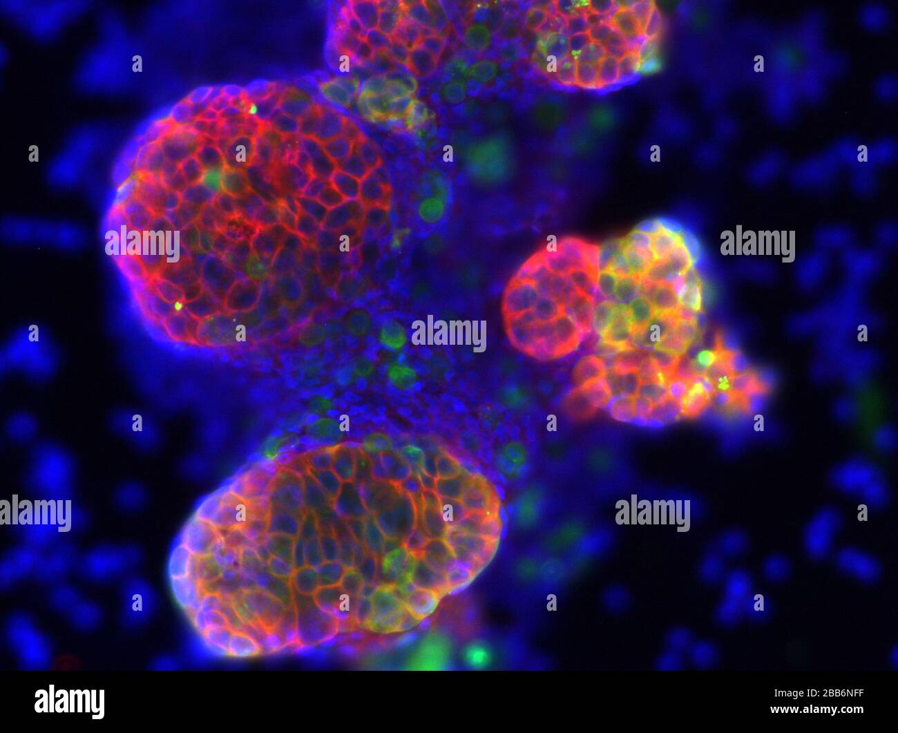 Tumor markers hi-res stock photography and images - Alamy