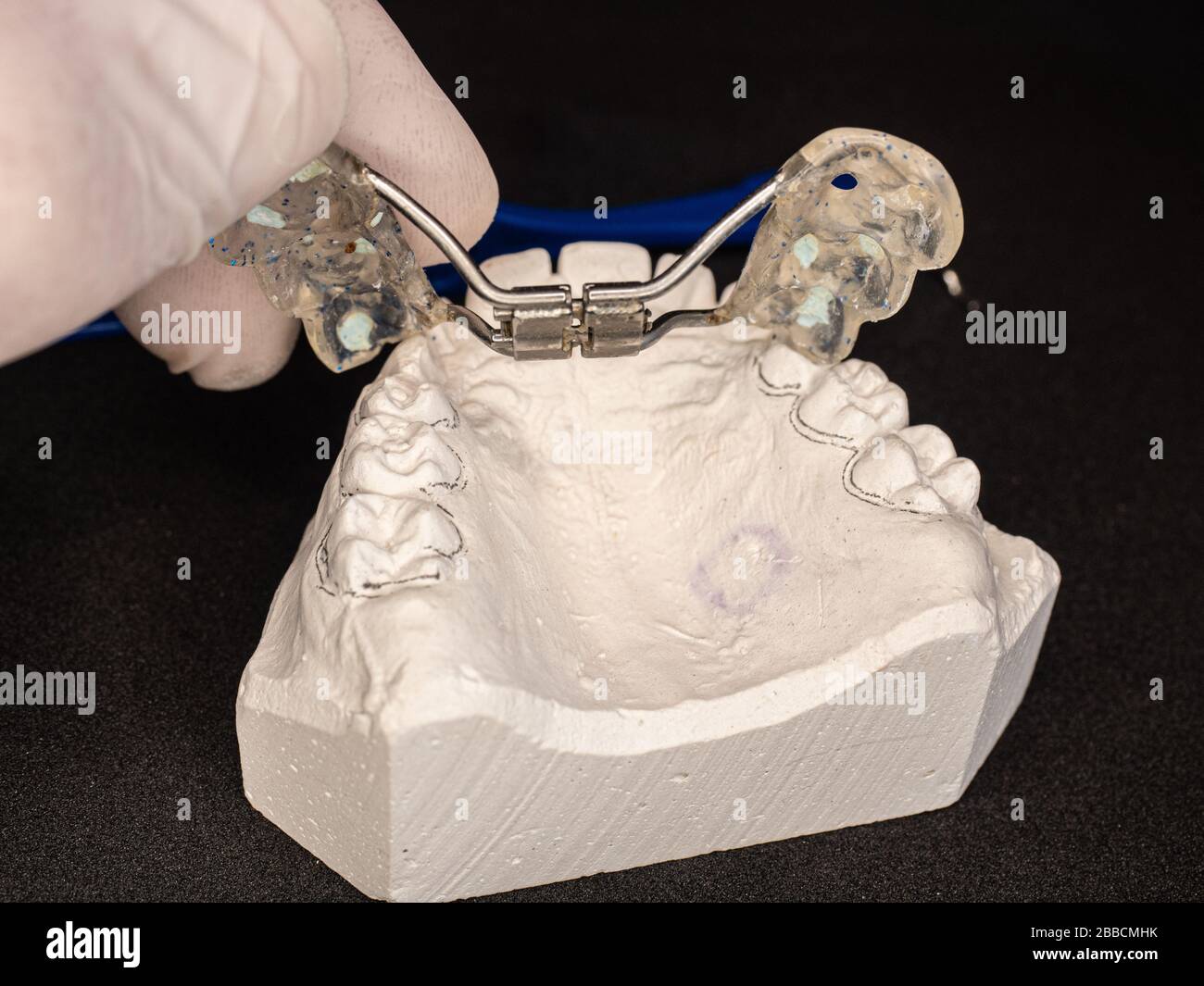 Palatal expander for the maxilla, setting test. The removable ...