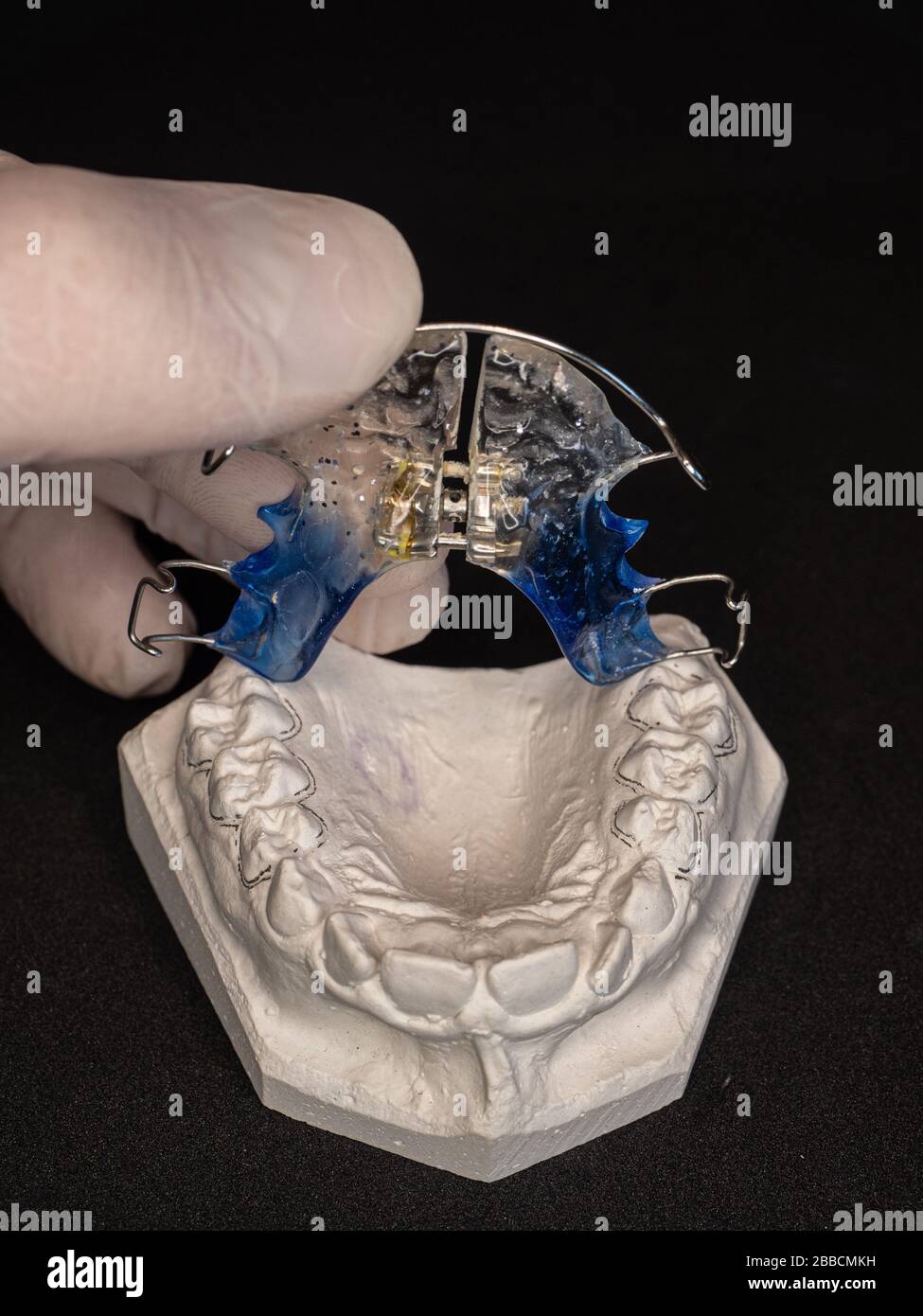 Retainer Designs Like Brace Blue