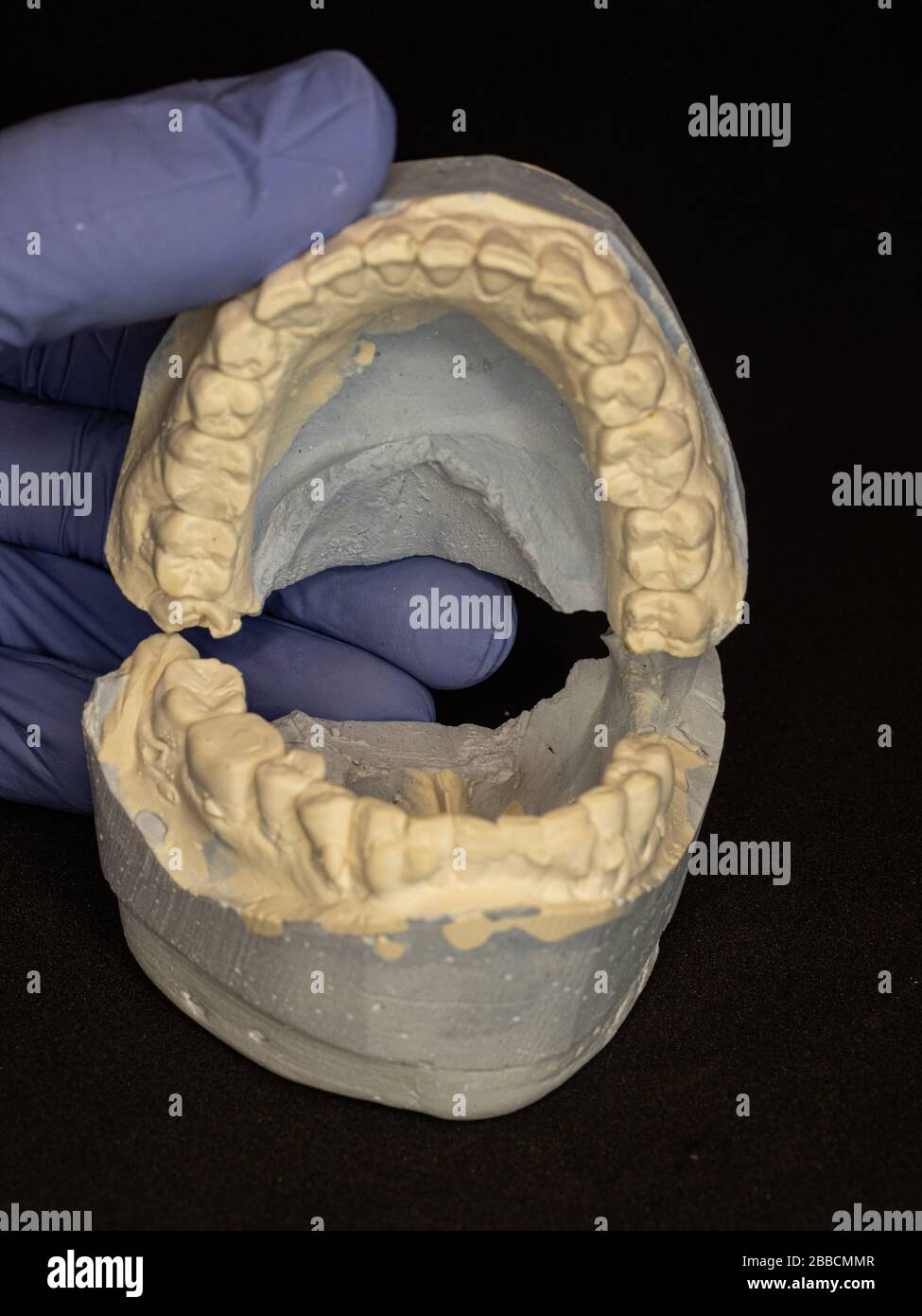 Dental gypsum model mould of teeth in plaster. Jaws defects with impact ...