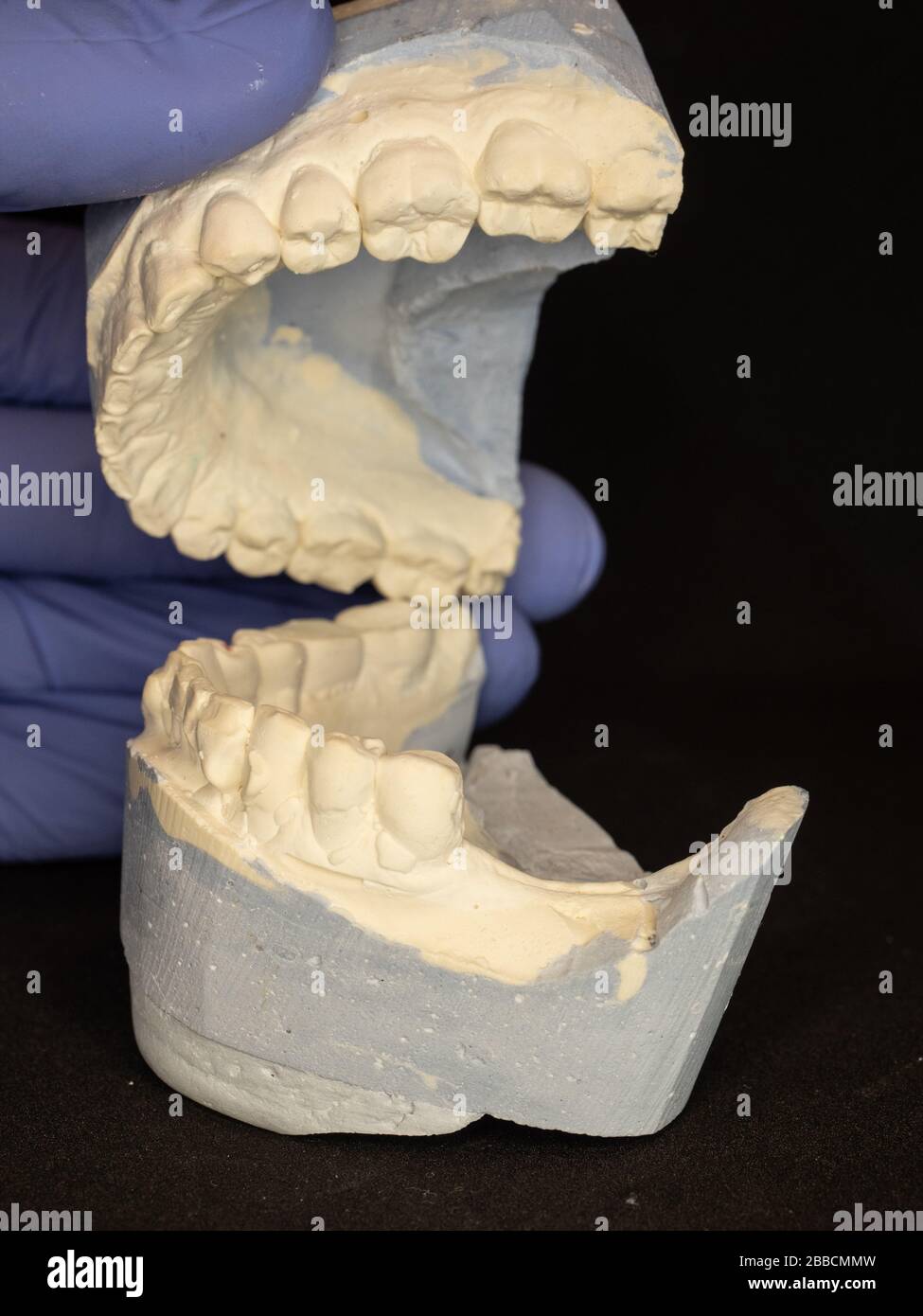 Modern orthodontic teeth cast. Visualisation of jaws defects on colored ...