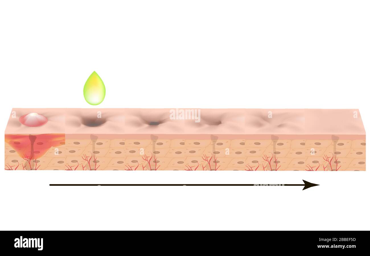 Atrophic scars. Acne scar. The anatomical structure of the skin with ...