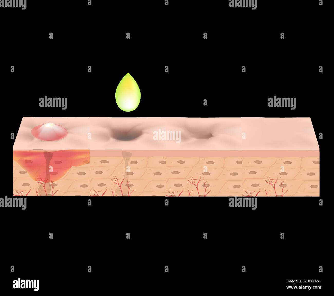 Atrophic scars. Acne scar. The anatomical structure of the skin with ...
