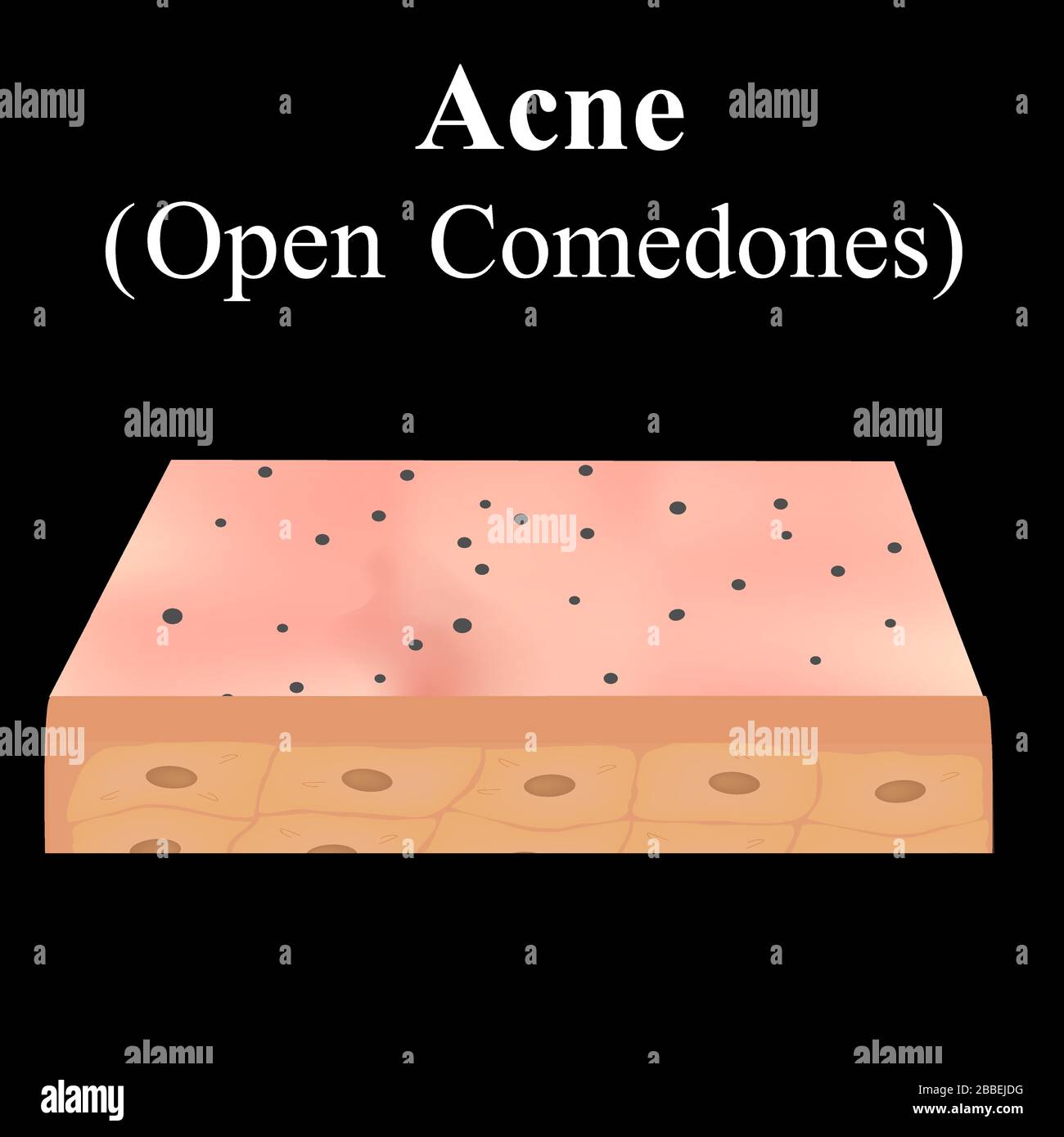 Bacterial acne Stock Vector Images - Alamy