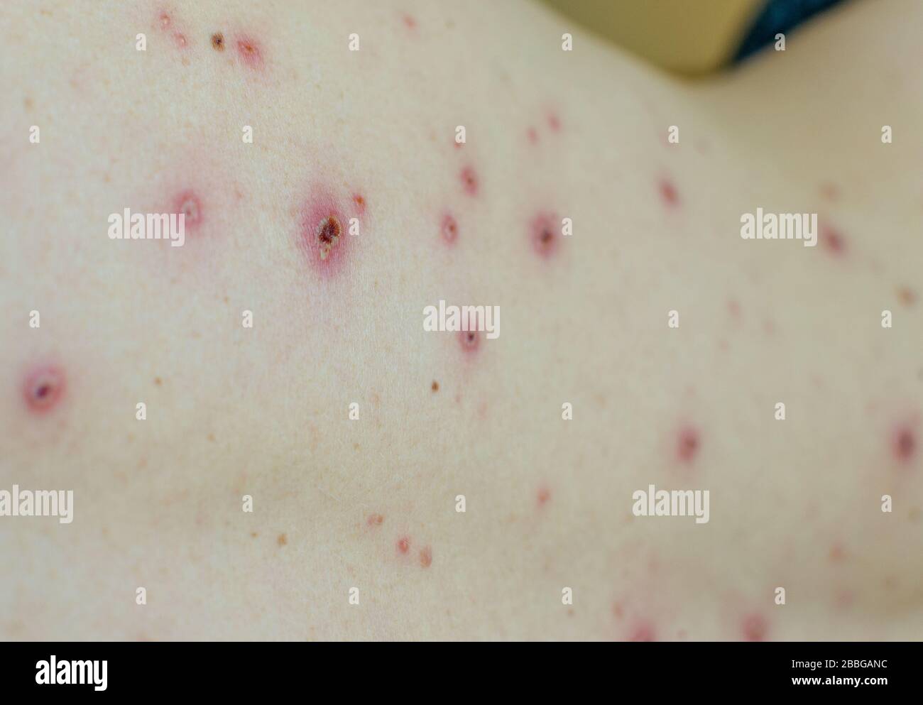 Large spots and pimples acne on the body - adult body with chickenpox ...