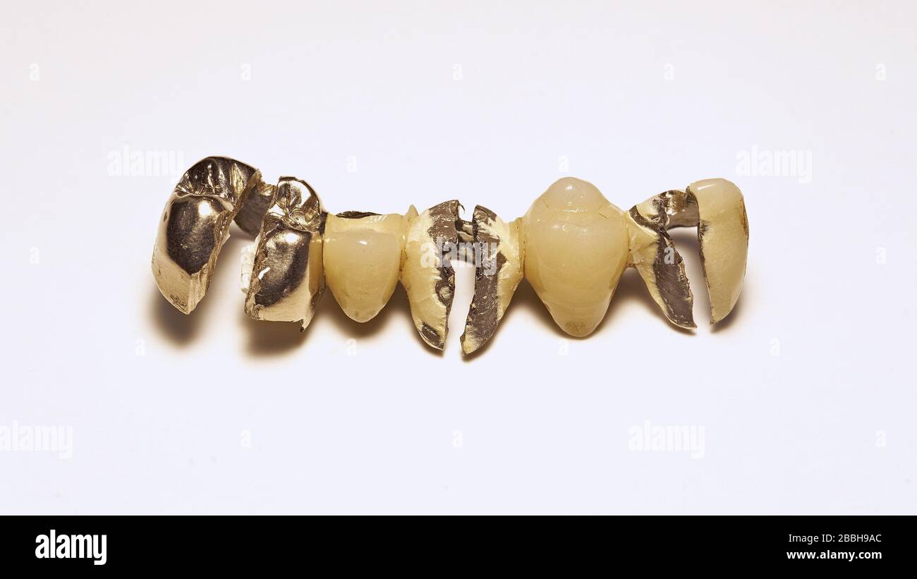 Detail of an old dental bridge cut open Stock Photo - Alamy
