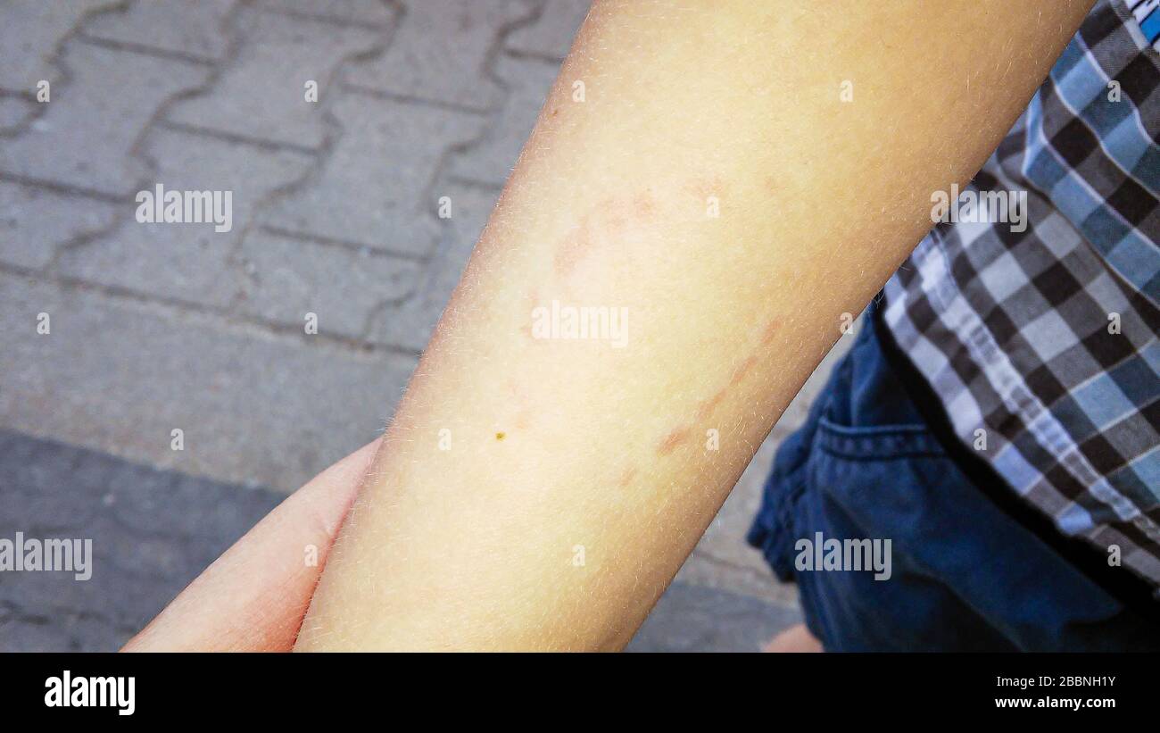 Toddler's bite marks on another kids arm - aggressive toddlers behavior ...