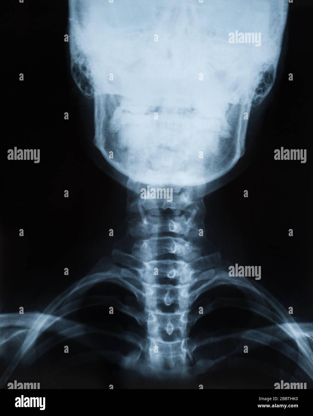 X-ray image of human cervical spine - neck Stock Photo - Alamy