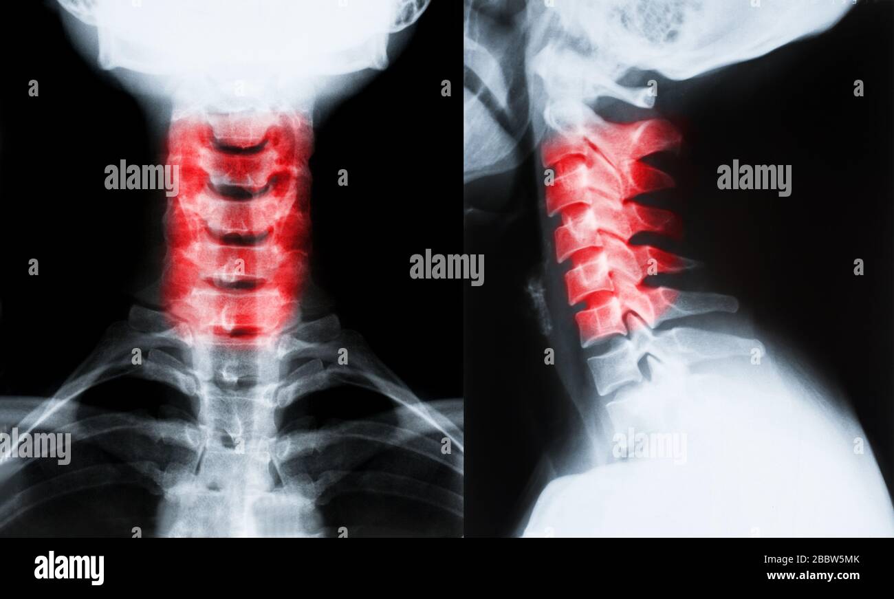 Healthy Cervical Spine Xray
