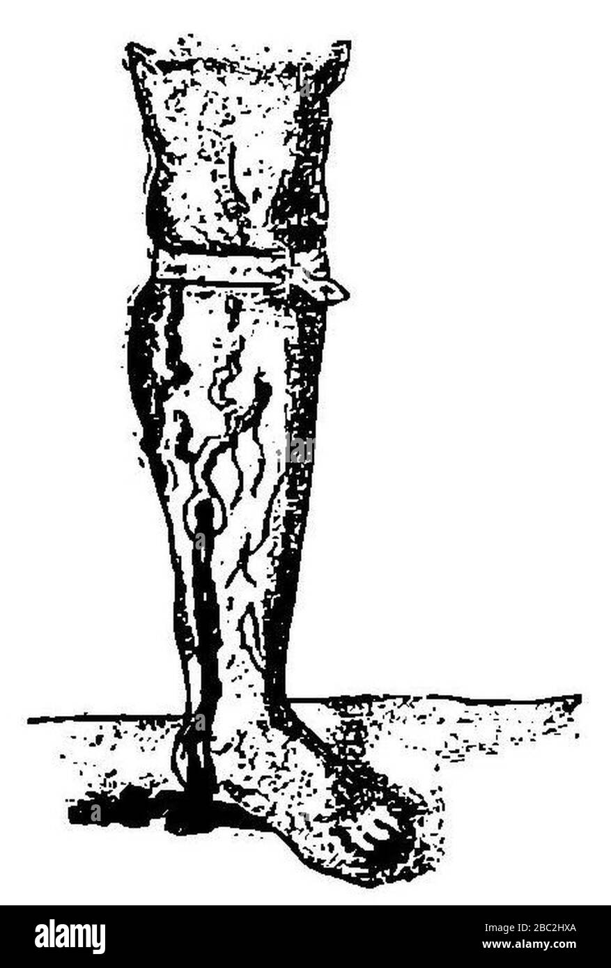 Grierson 58 Pierna con hemorragia venosa Stock Photo - Alamy