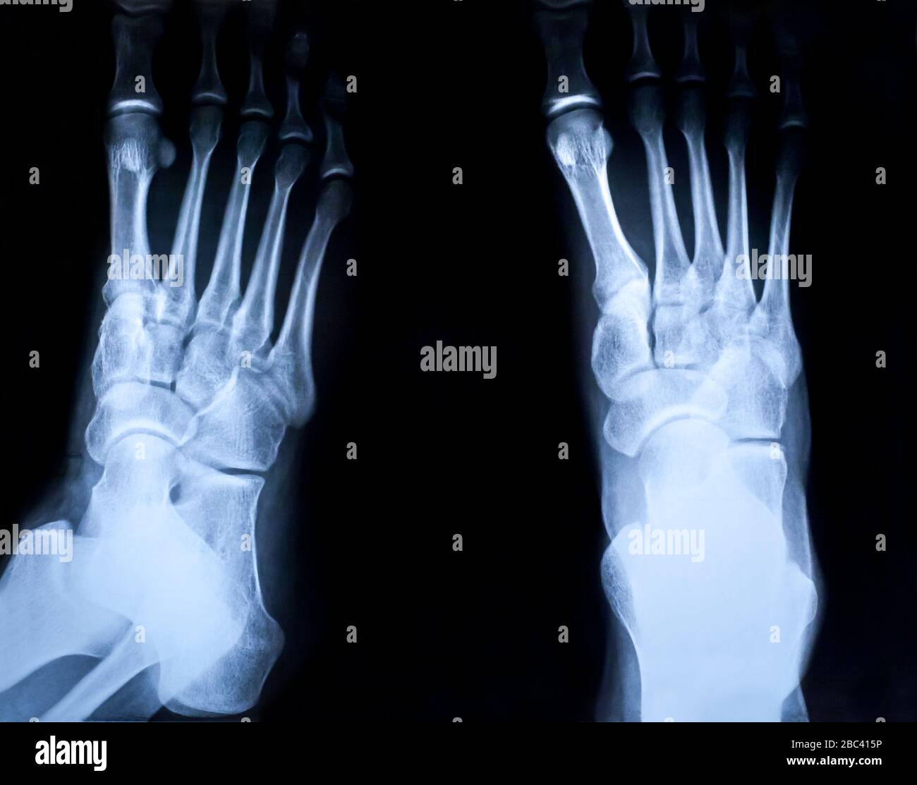 Human foots ankle and leg x-ray picture Stock Photo - Alamy