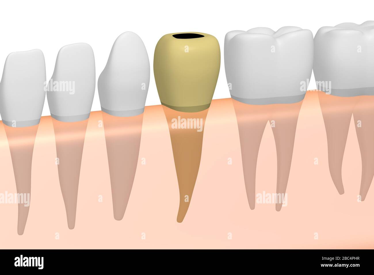 Decayed teeth hi-res stock photography and images - Alamy