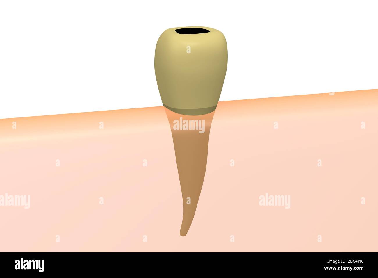Rotten tooth hi-res stock photography and images - Alamy