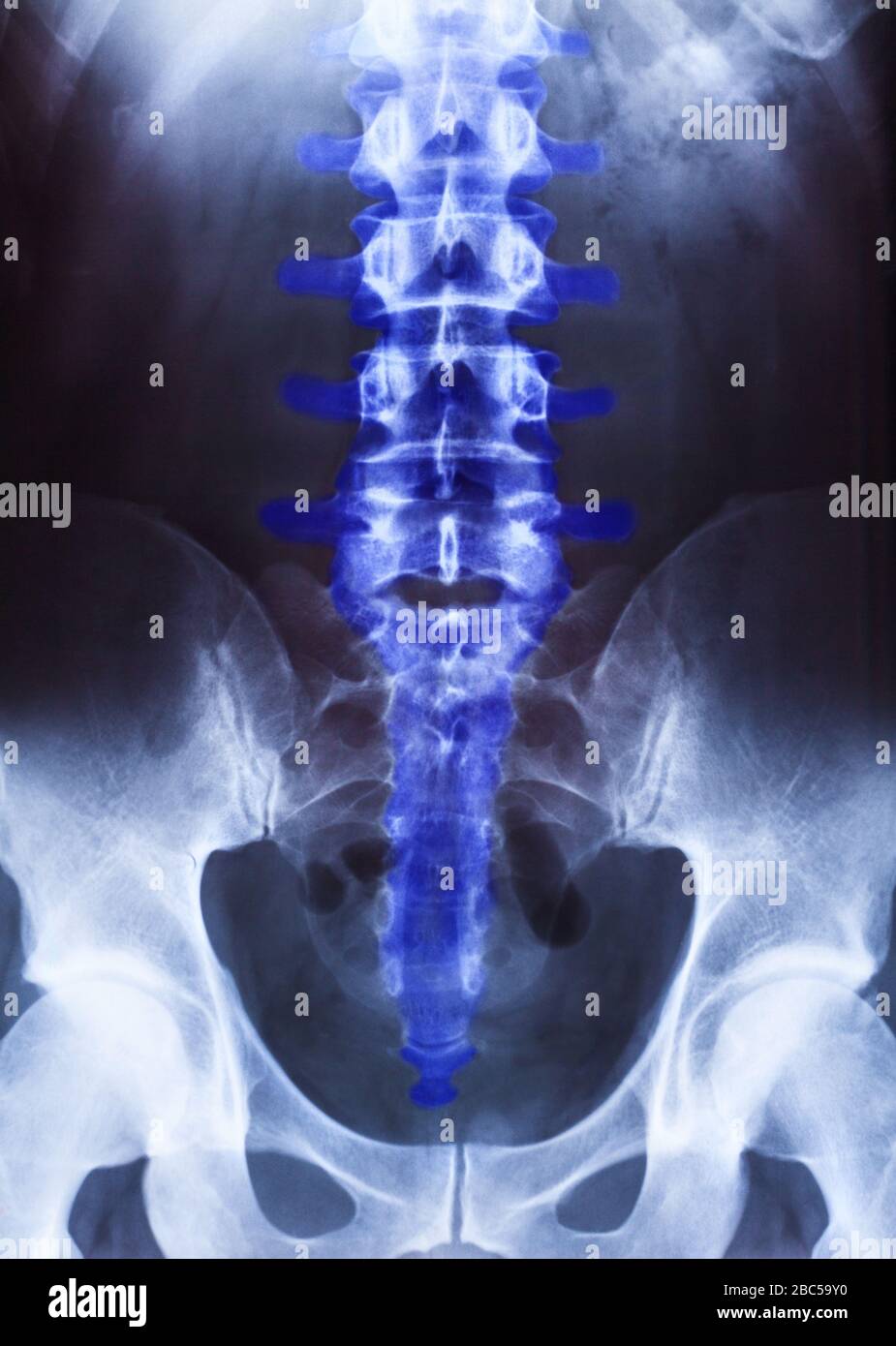 X-ray photography of the human lumbo-sacral pelvis and spinal column of ...