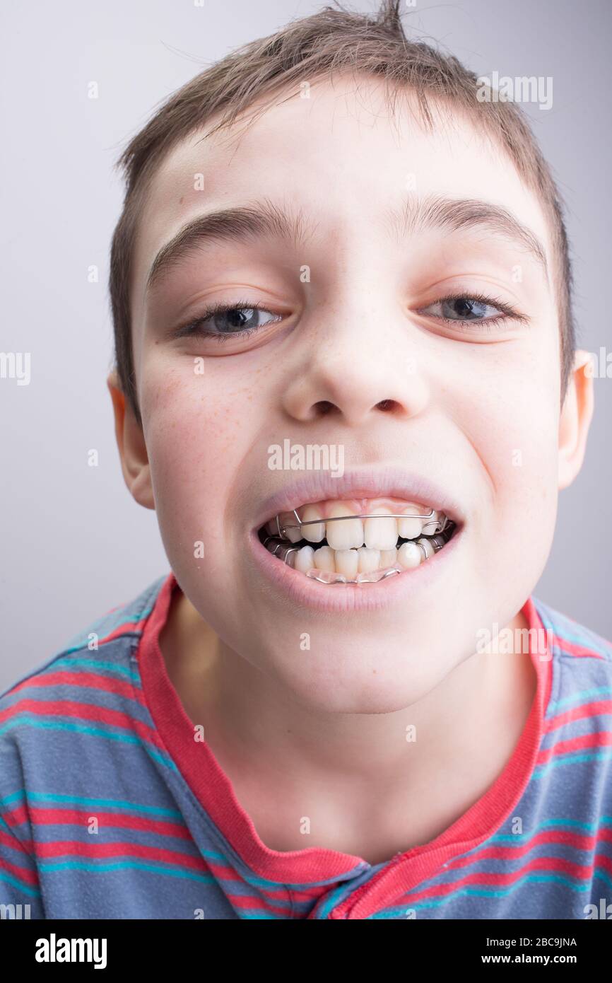 small boy smiling with orthodontic appliance Stock Photo - Alamy