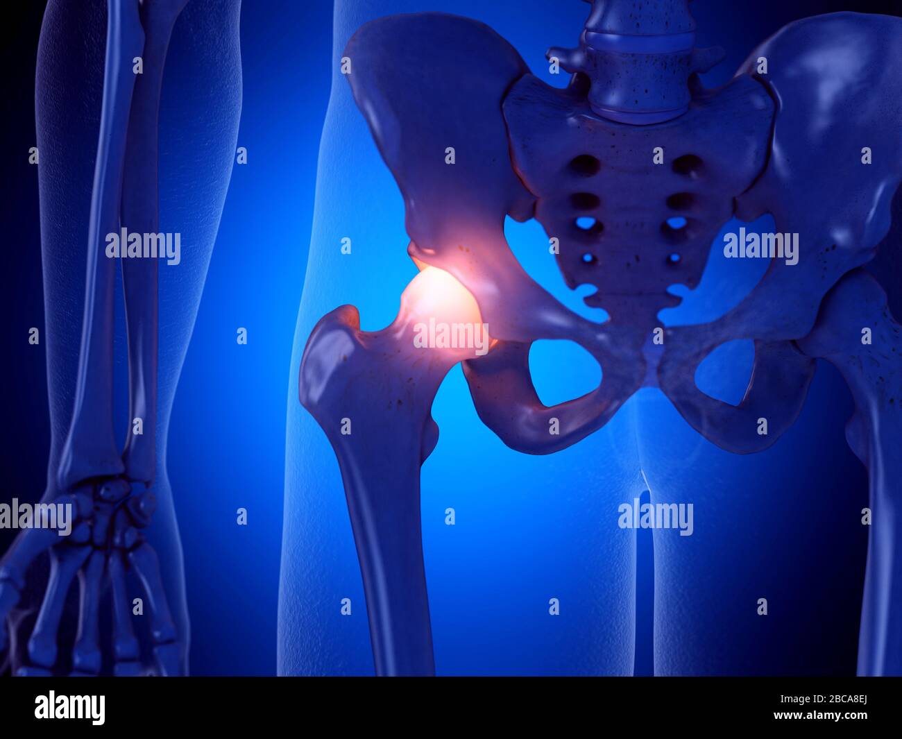 Hip joint infection hi-res stock photography and images - Alamy