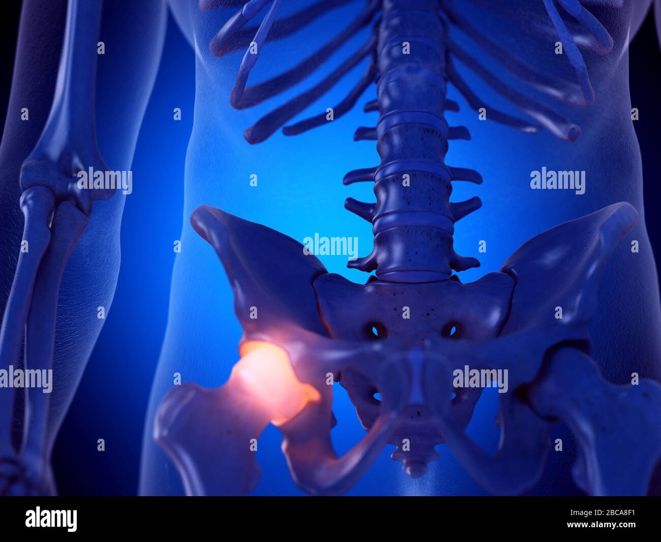 Hip joint infection hi-res stock photography and images - Alamy