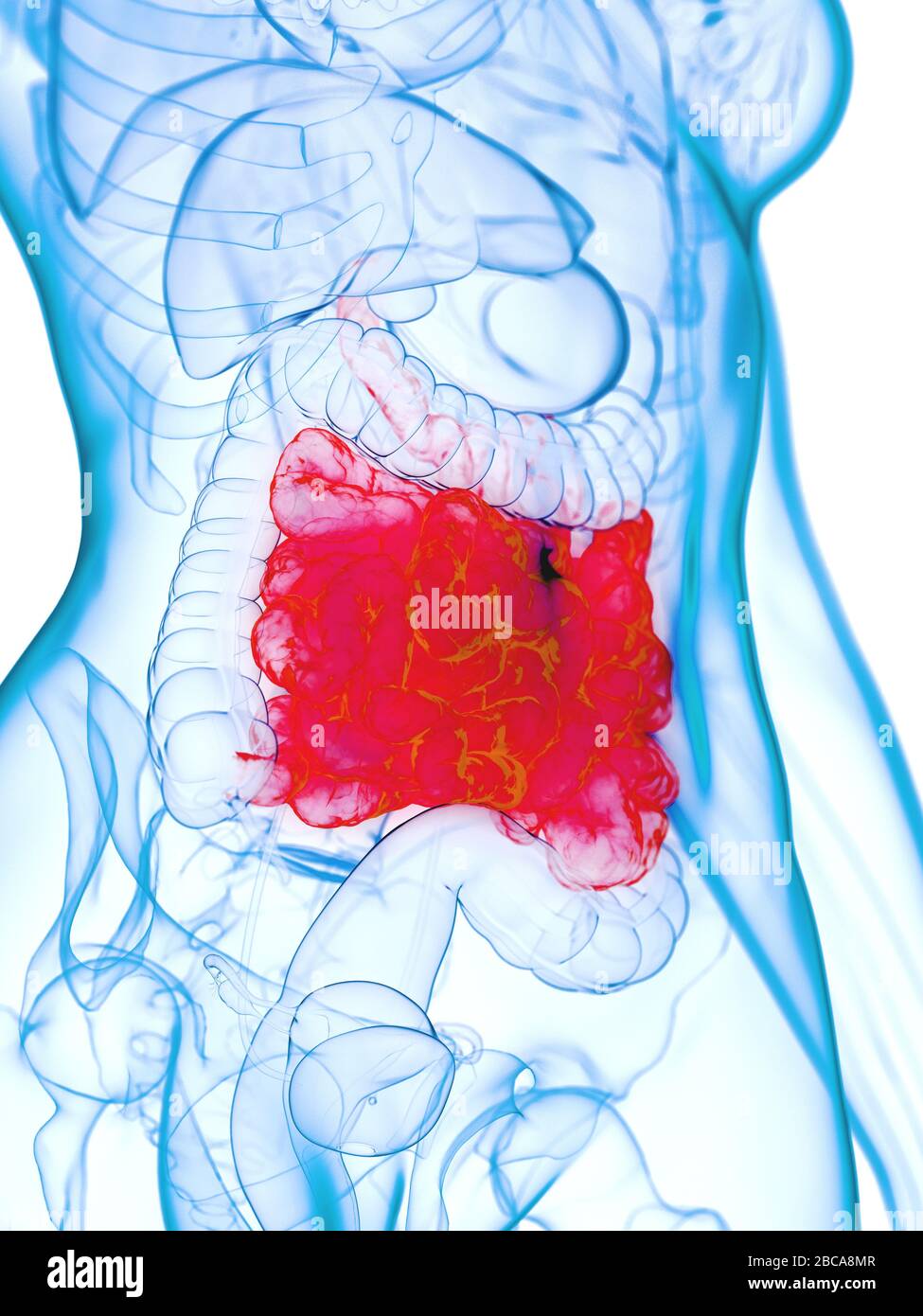 Diseased small intestine, illustration Stock Photo - Alamy