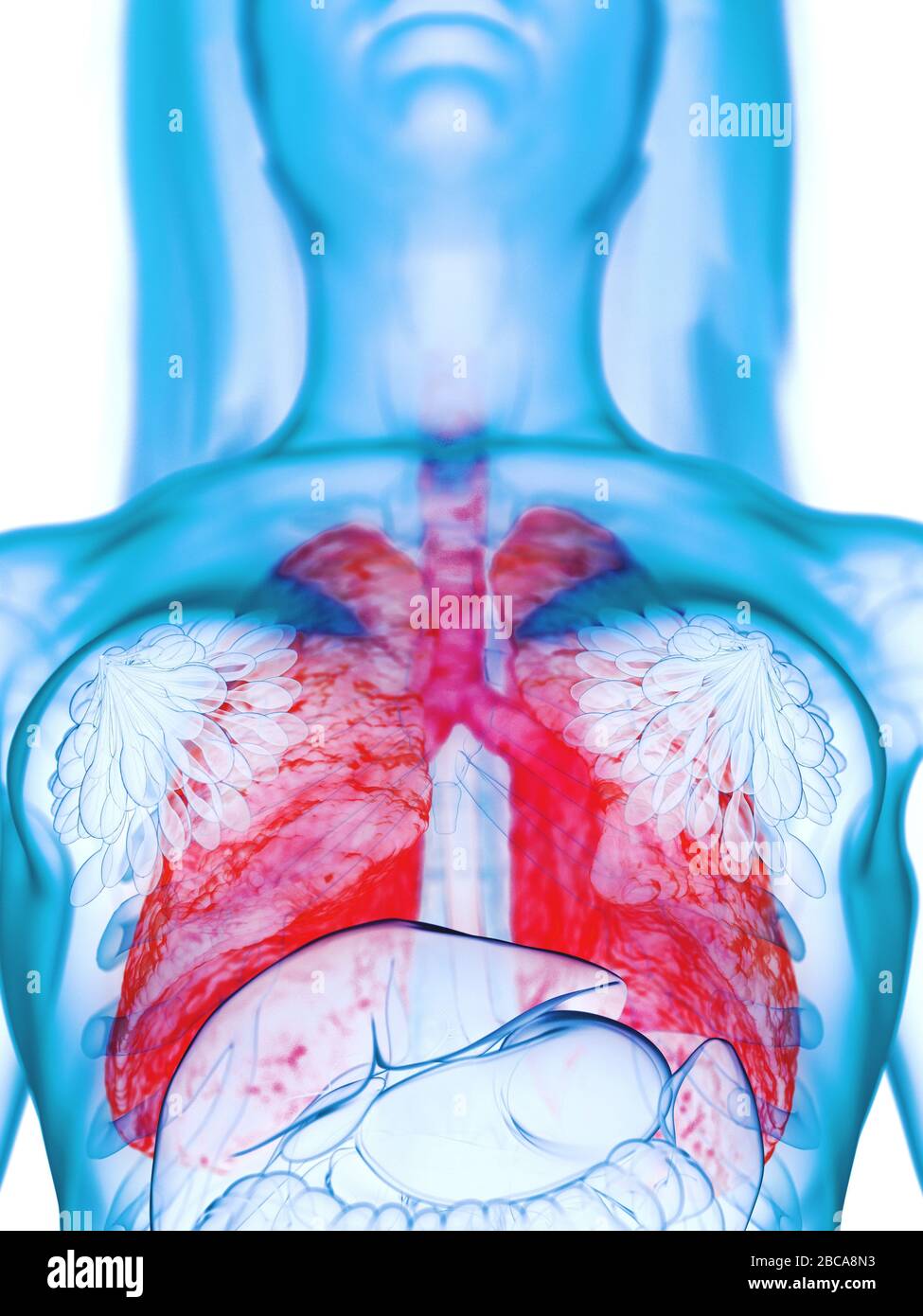 Diseased lung, illustration Stock Photo - Alamy