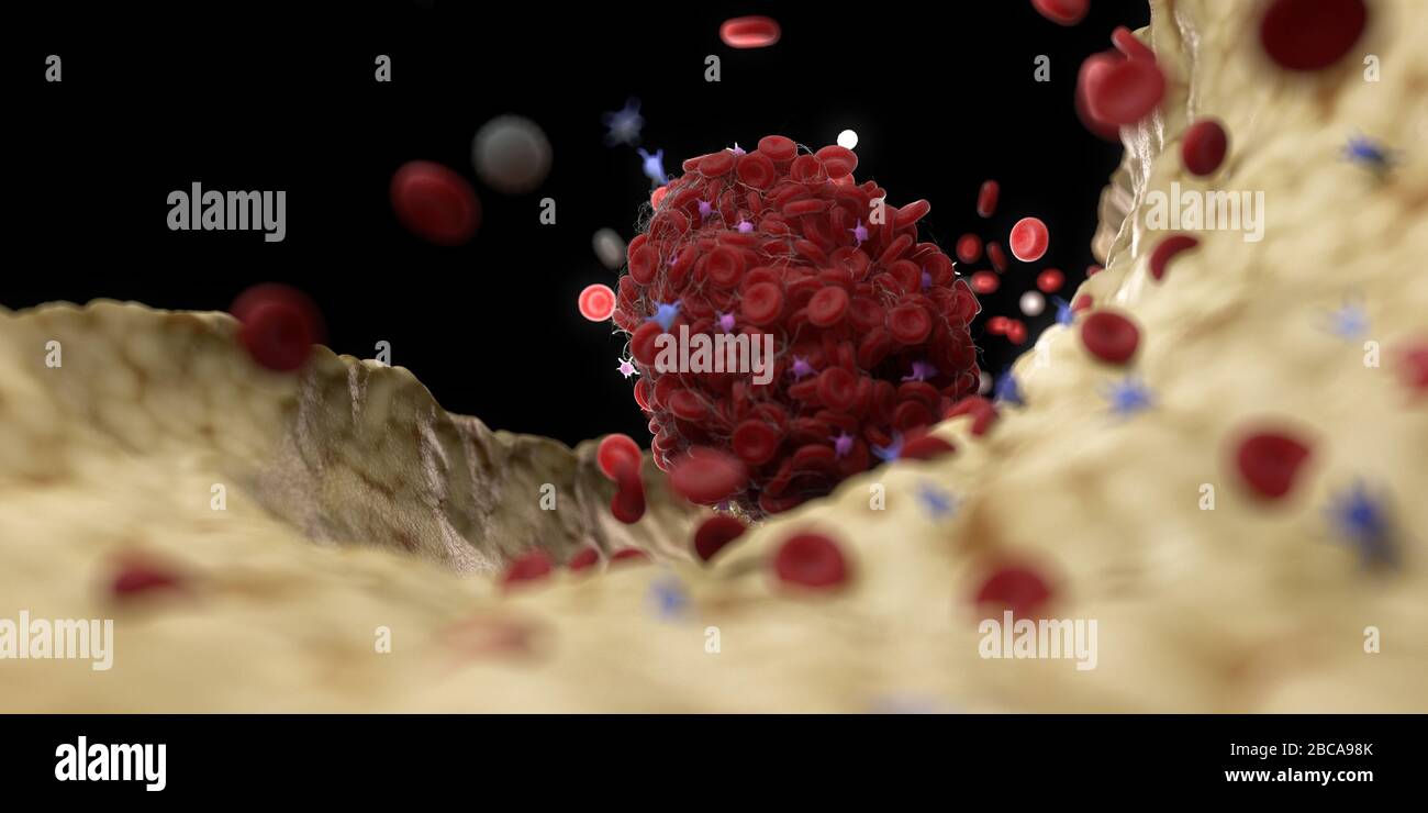 Thrombus hi-res stock photography and images - Alamy
