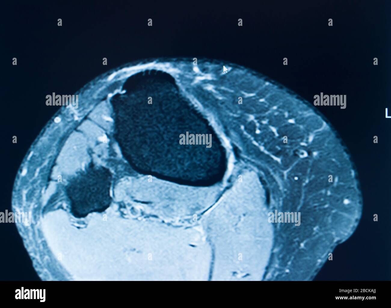 Knee sports injury mri mcl grade 2 tear magnetic resonance imaging ...