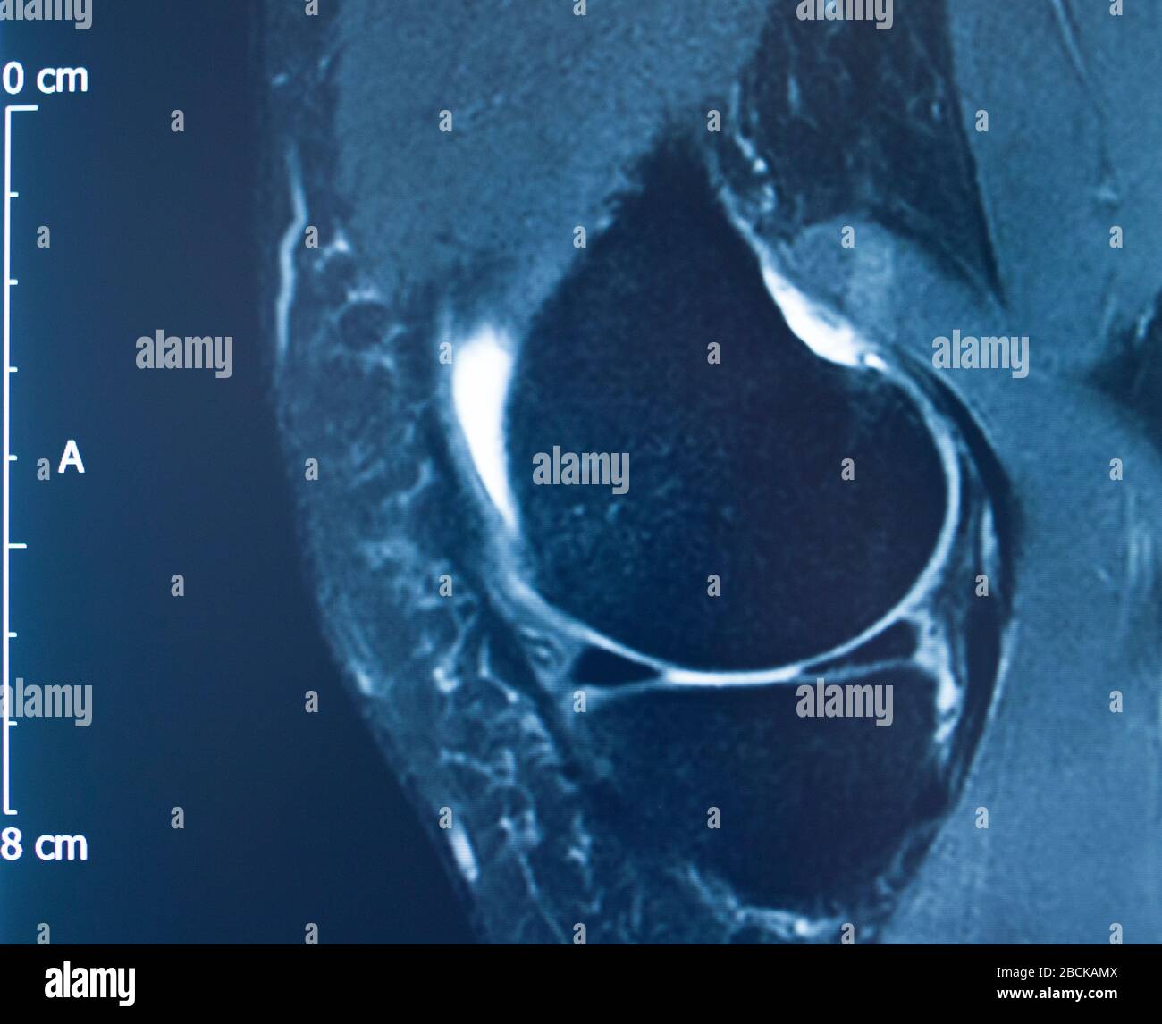 Knee sports injury mri mcl grade 2 tear magnetic resonance imaging ...