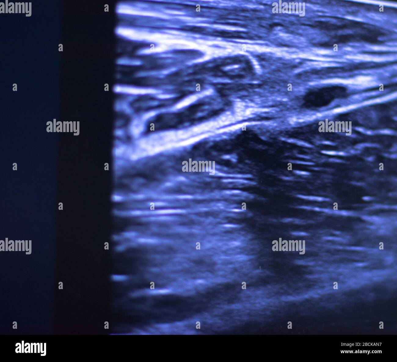 EPI Intratissue Percutaneous Electrolysis dry needling ultrasound ecography scan physiotherapy ...