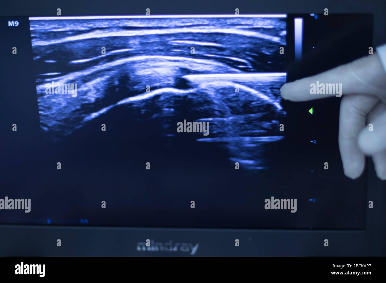 EPI Intratissue Percutaneous Electrolysis dry needling ultrasound ...