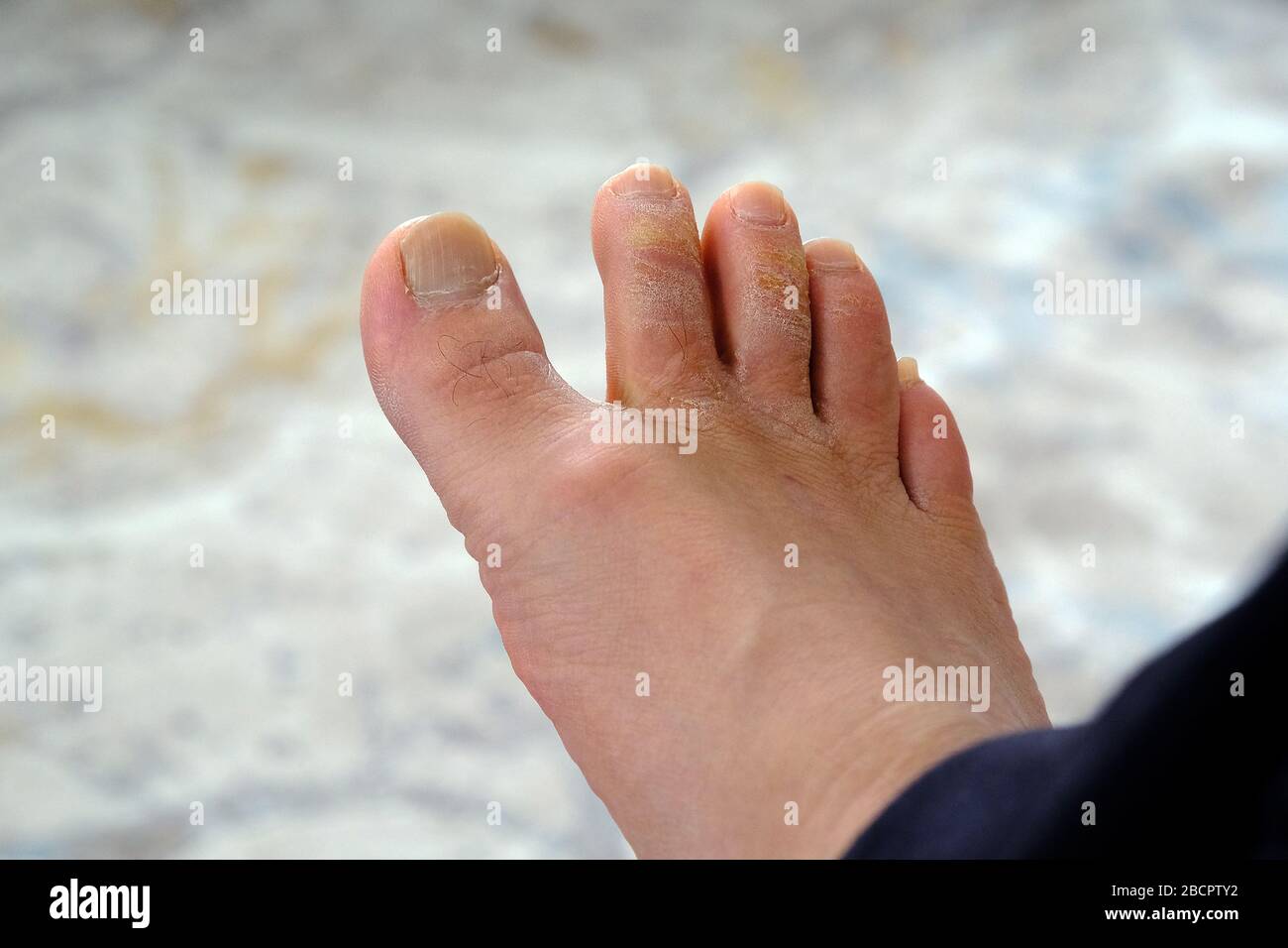 fungal disease on the toes, fungus formation on the toes, human foot ...