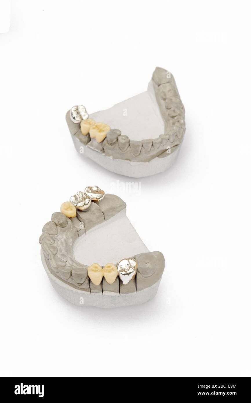 metal-ceramic dental crowns and bridges. dental prosthetics. artificial ...