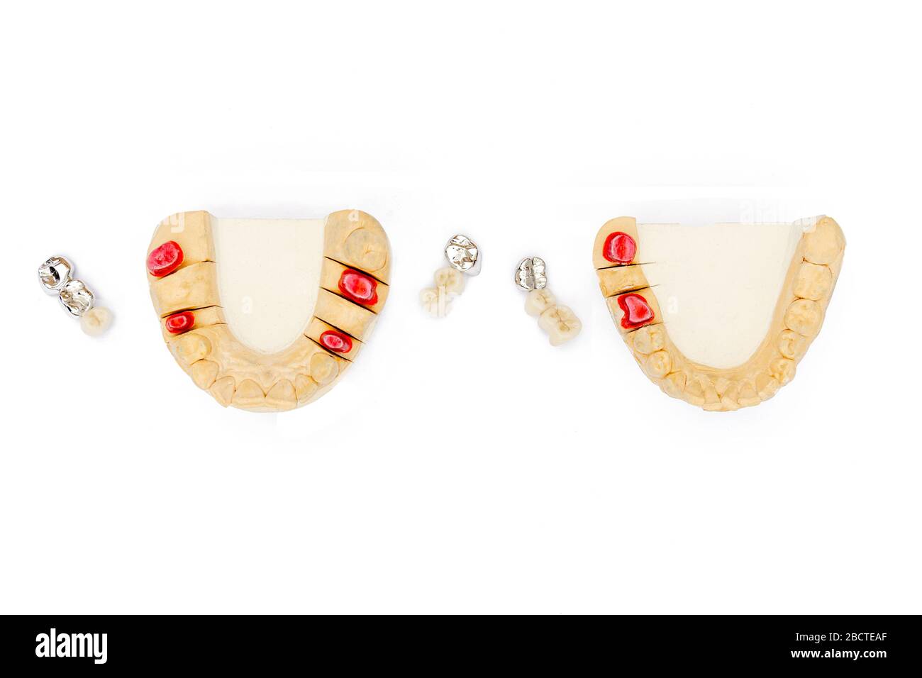 dental crowns and bridges. ceramic-metal crowns. dental prosthetics ...